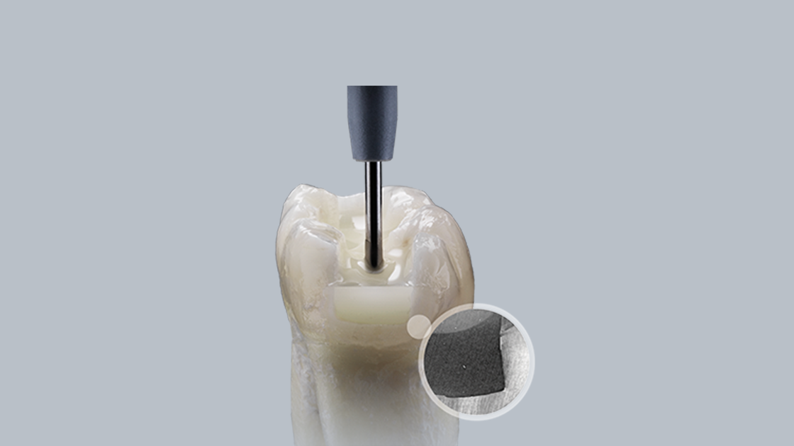Guide to Class II Restoration Procedures | Dentsply Sirona