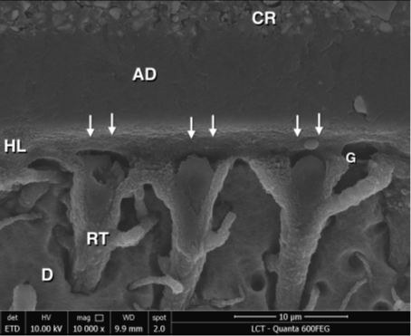 Post-OP Sensitivity in Composite Restorations | Dentsply Sirona