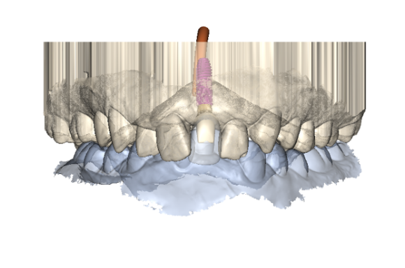 Anterior Single-Tooth Implant Procedures | Dentsply Sirona Ireland