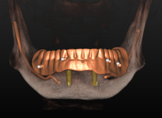 Full-Arch Implant Overdentures | Dentsply Sirona Ireland