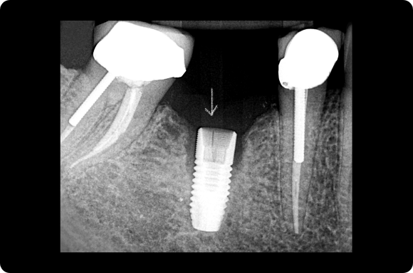 Management of Dental Implant Complications | Dentsply Sirona Ireland