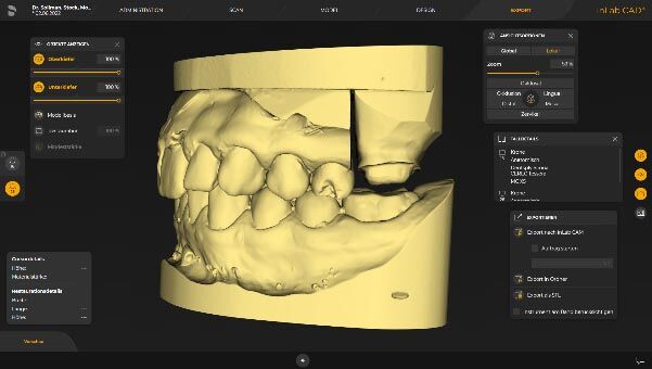 MIH Teeth Treatment: CEREC Tessera Restoration | Dentsply Sirona Ireland