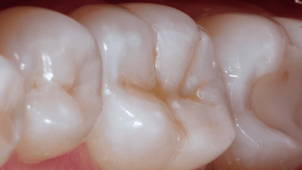 Class II Dental Cases | Dentsply Sirona Ireland