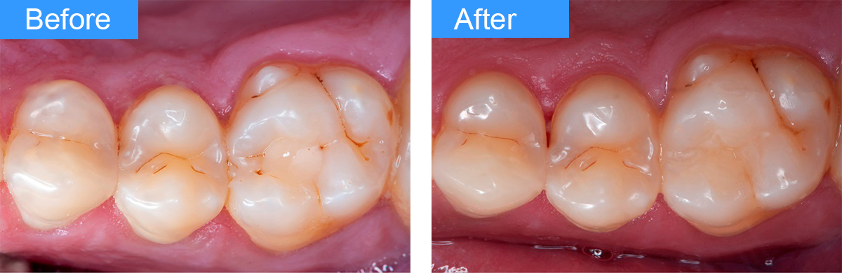 Distal Occlusal Restoration in Asymptomatic Patient | Dentsply Sirona India