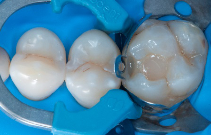 Distal Occlusal Restoration in Asymptomatic Patient | Dentsply Sirona India