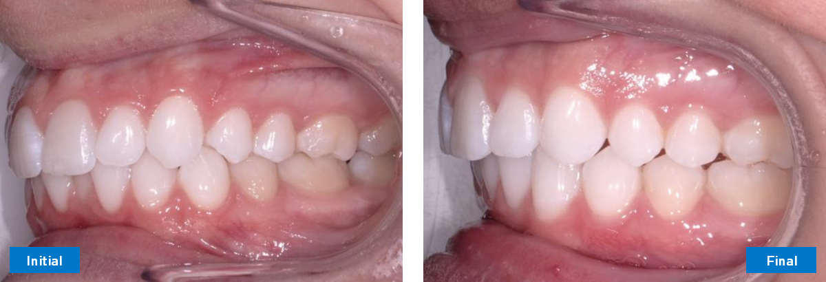 Class I with Class III tendency - Crowding (SureSmile® Aligners) India