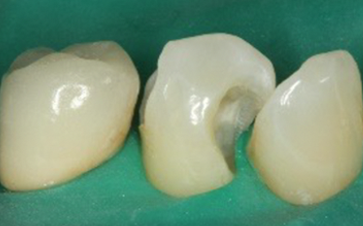 Neo Spectra ST Flow | Dentsply Sirona India