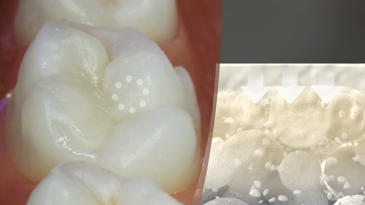 Neo Spectra ST | Dentsply Sirona India