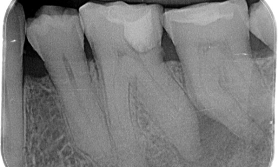Clinical Case Collection | TruNatomy | Dentsply Sirona IN
