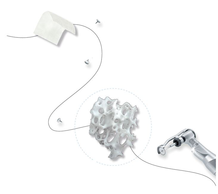Dental Implant Parts | Dentsply Sirona USA India