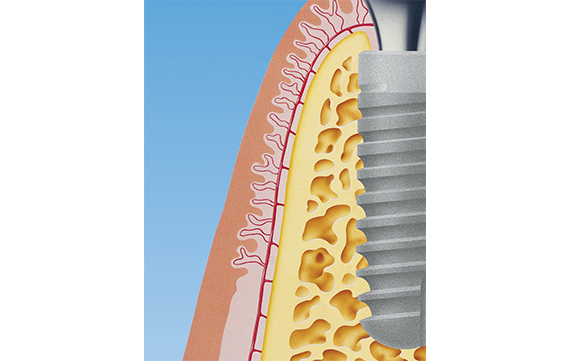Dental Implant Parts | Dentsply Sirona USA India