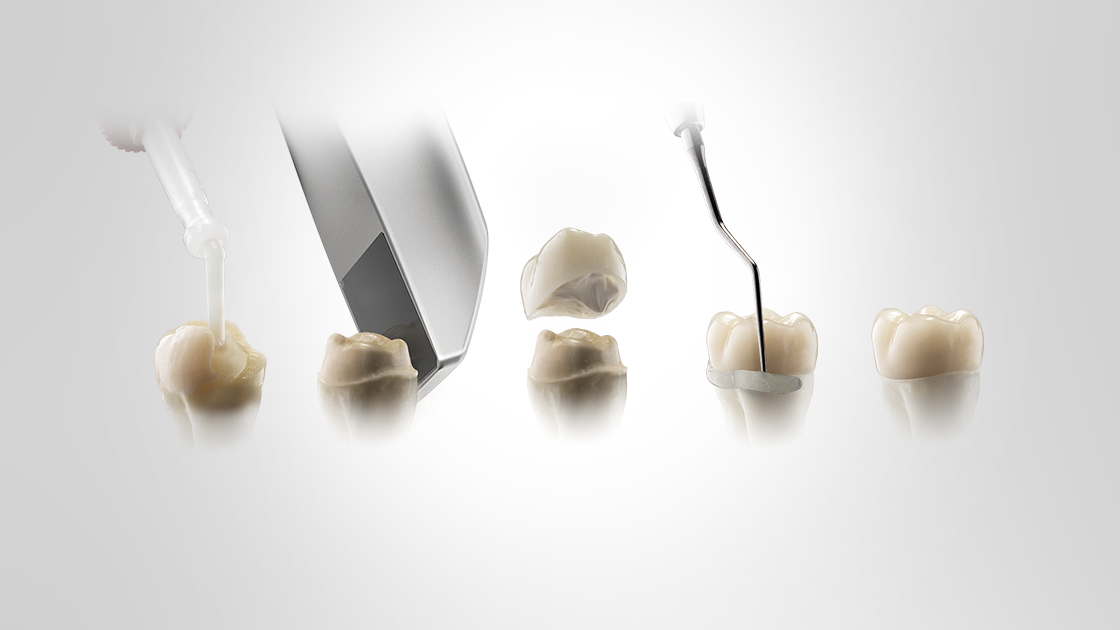 Single-Unit Crown Workflow Solutions India