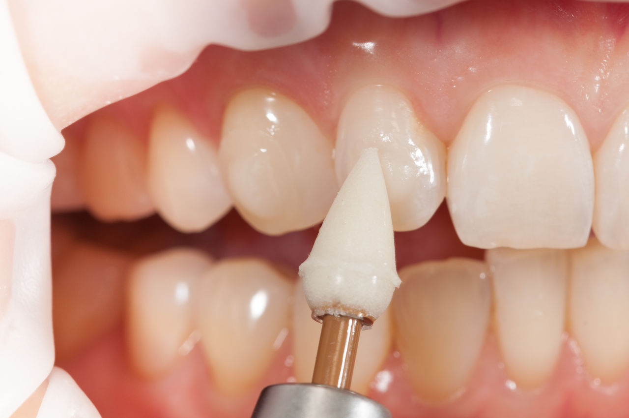 TPH Spectra® ST universal composite for aligner attachments | Dentsply ...