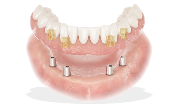 Denture Base Materials: Discover now! | Dentsply Sirona Sweden