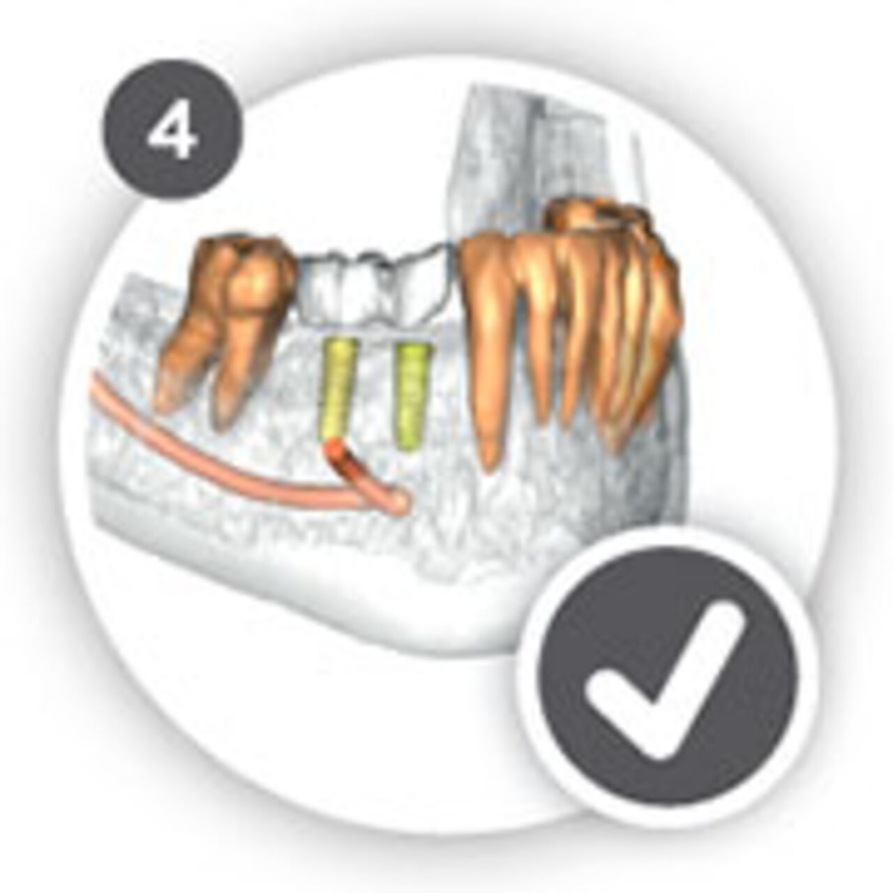 Simplant Implant Planning Software | Dentsply Sirona