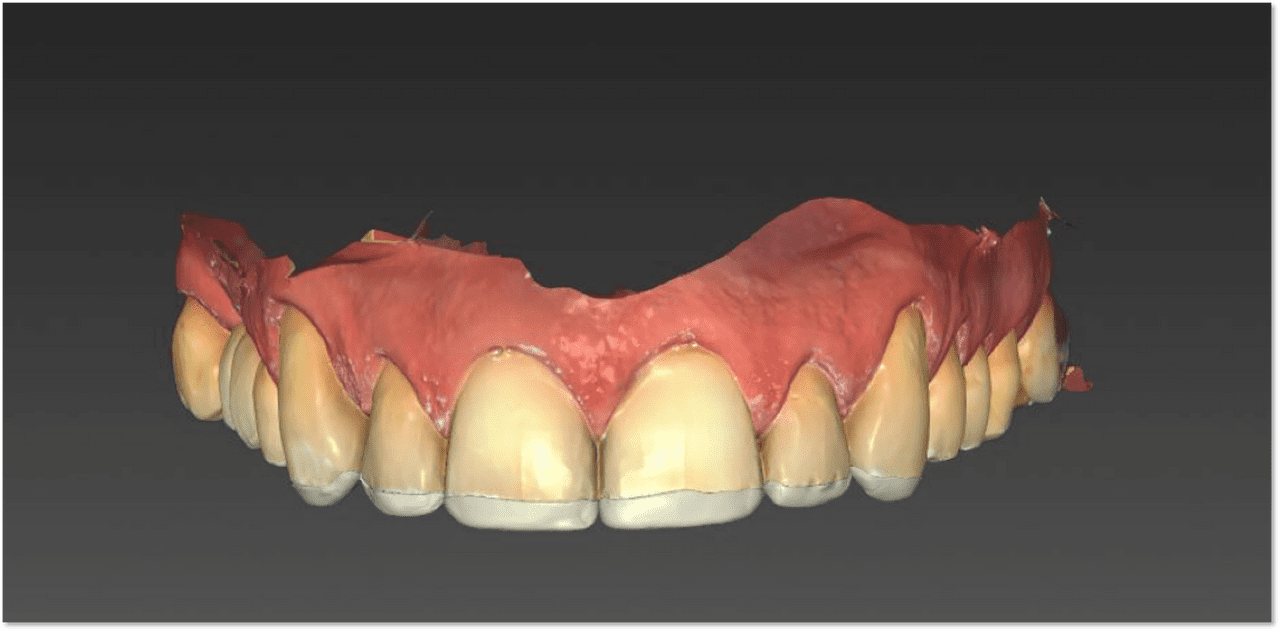 Digital Impressions: Benefits & Use Cases | Dentsply Sirona