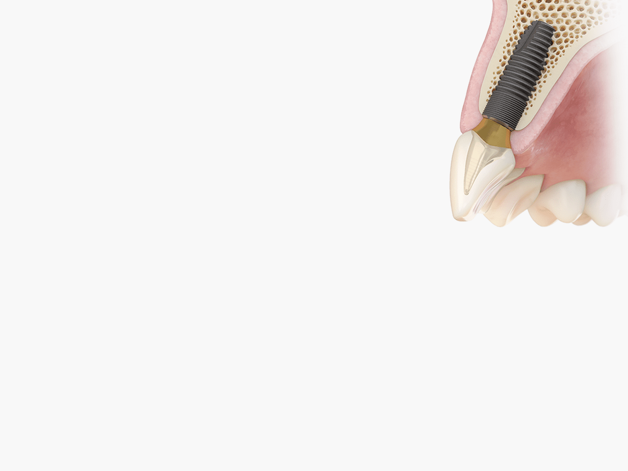 Dental Implants Course Series I Dentsply Sirona USA