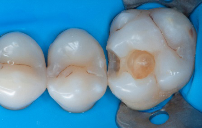 Distal Occlusal Restoration in Asymptomatic Patient | Dentsply Sirona USA