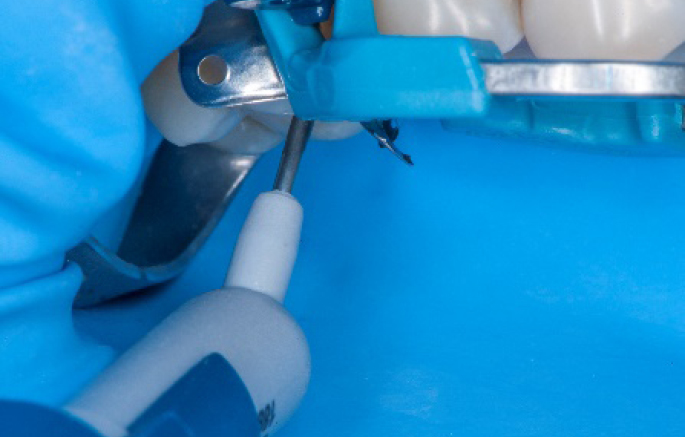 Distal Occlusal Restoration in Asymptomatic Patient | Dentsply Sirona USA