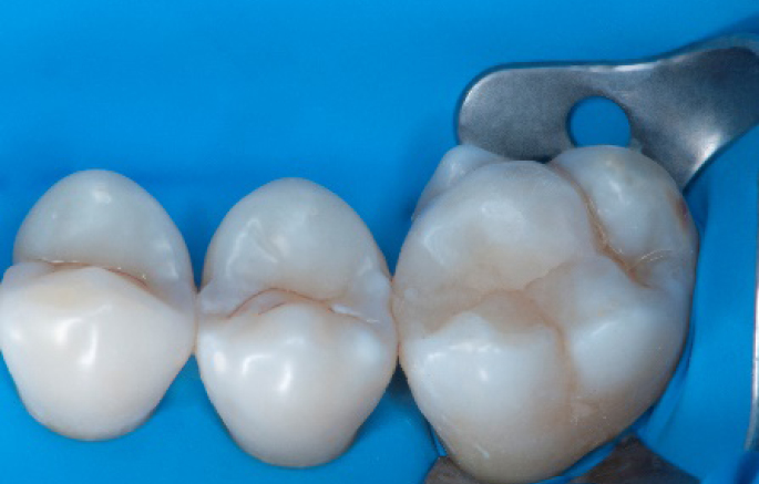 Distal Occlusal Restoration in Asymptomatic Patient | Dentsply Sirona USA