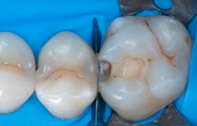 Distal Occlusal Restoration in Asymptomatic Patient | Dentsply Sirona USA