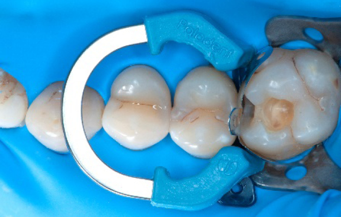 Distal Occlusal Restoration in Asymptomatic Patient | Dentsply Sirona USA