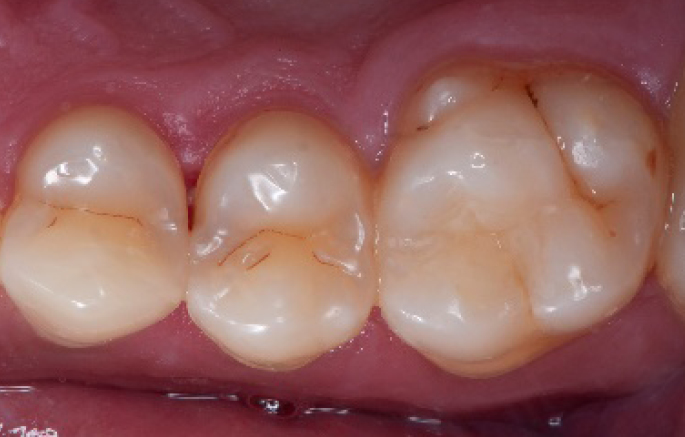 Distal Occlusal Restoration in Asymptomatic Patient | Dentsply Sirona USA