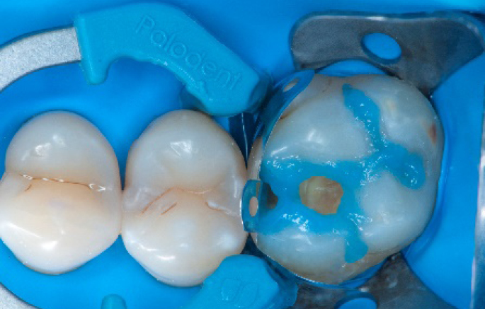 Distal Occlusal Restoration in Asymptomatic Patient | Dentsply Sirona USA