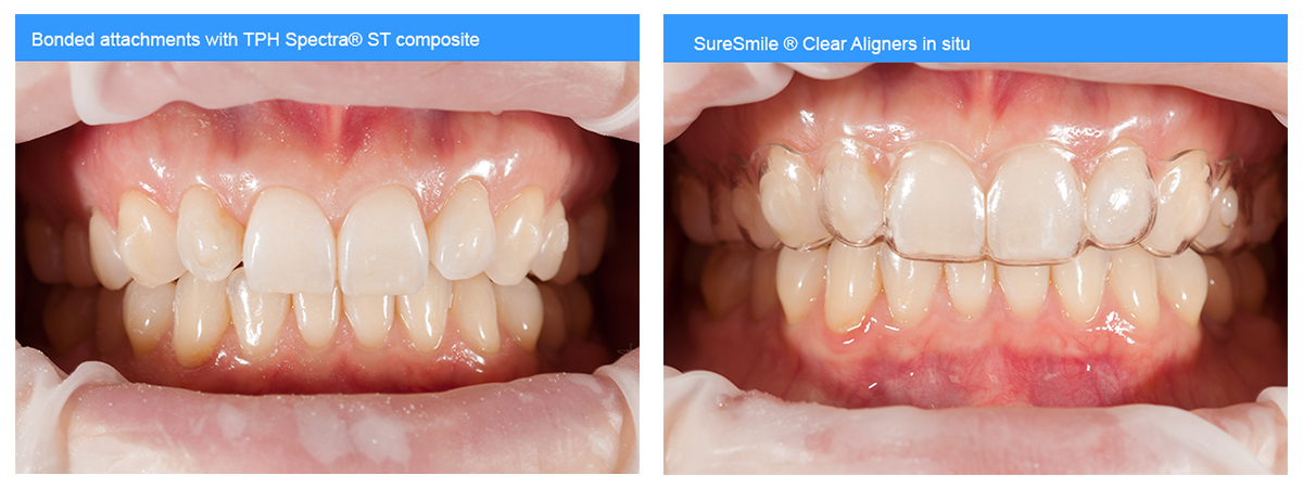 SureSmile Attachment Bonding with TPH Spectra® ST | Dentsply Sirona USA