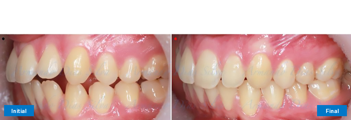 Class II, Div 1 – Central Incisor Protrusion and Anterior Spaces ...