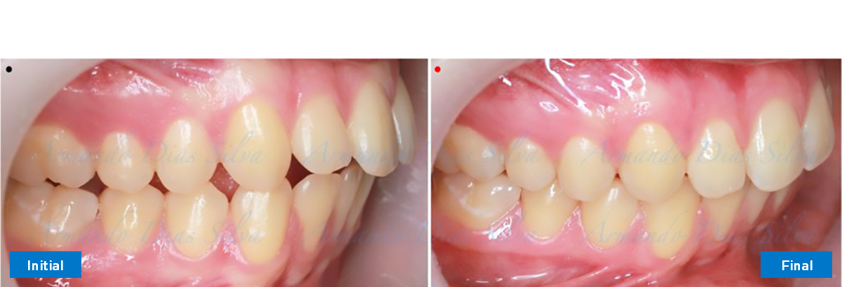 Class II, Div 1 – Central Incisor Protrusion and Anterior Spaces ...