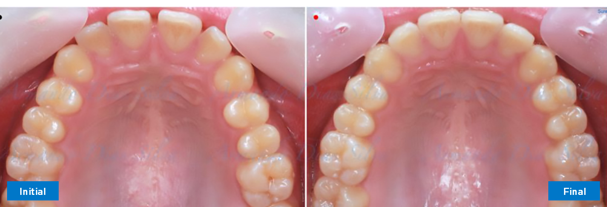Class II, Div 1 – Central Incisor Protrusion and Anterior Spaces ...