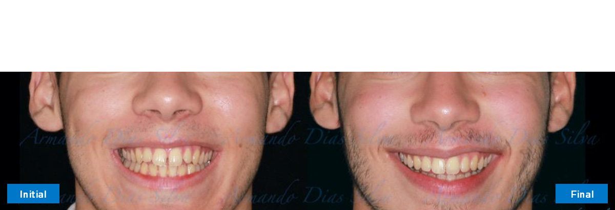Class II, Div 1 – Central Incisor Protrusion and Anterior Spaces ...