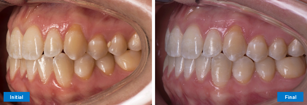 Class I – Crowding, Shallow Overbite (SureSmile® Aligners) USA
