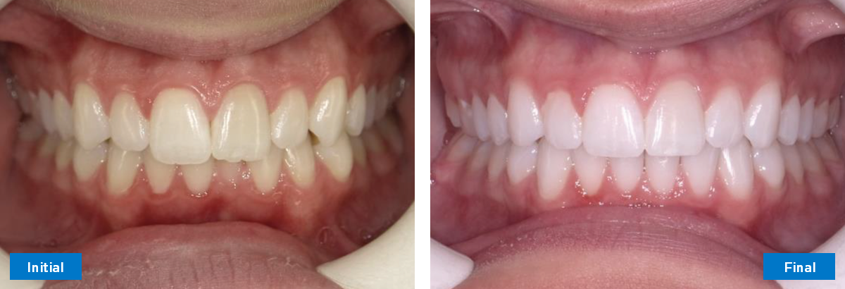 Class I with Class III tendency - Crowding (SureSmile® Aligners) USA