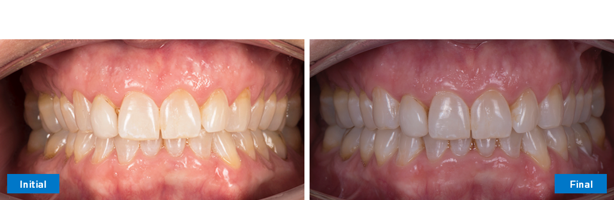 Mild Class II – Narrow Arches (SureSmile® Aligners) USA