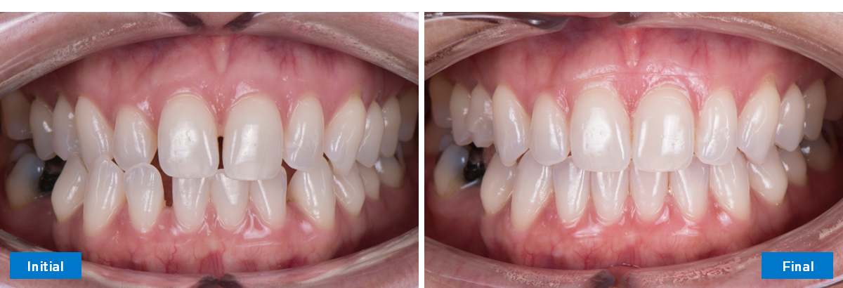 Mild Class 3 Malocclusion: SureSmile Case Study | Dentsply Sirona USA