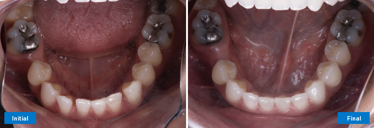 Mild Class 3 Malocclusion: SureSmile Case Study | Dentsply Sirona USA