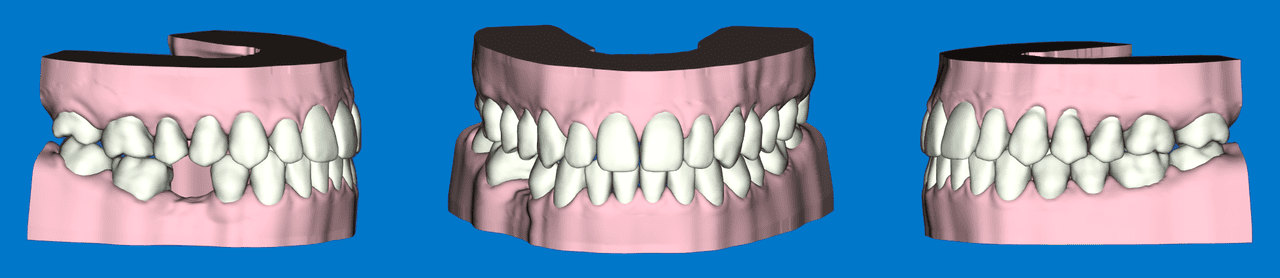 Mild Class 3 Malocclusion: SureSmile Case Study | Dentsply Sirona USA