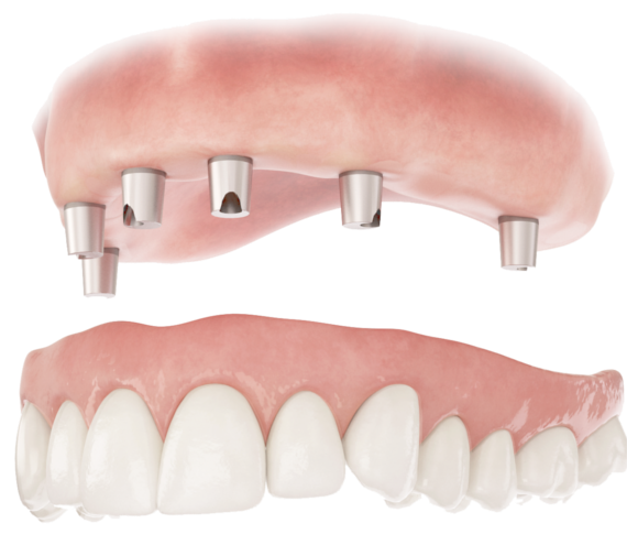 Atlantis Dental Abutments | Dentsply Sirona USA