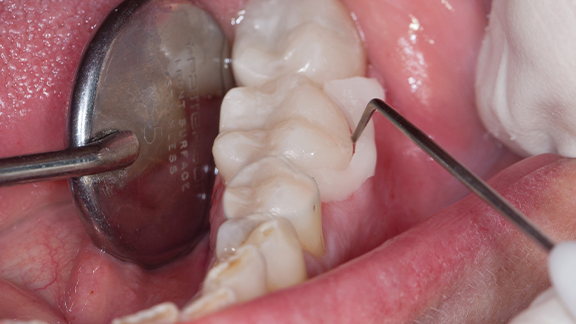 Calibra Universal+ - Versatile Resin Cement | Dentsply Sirona USA