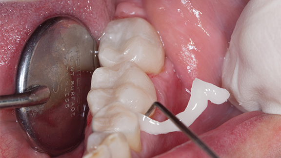 Calibra Universal: Self-Adhesive Resin Cement | Dentsply Sirona