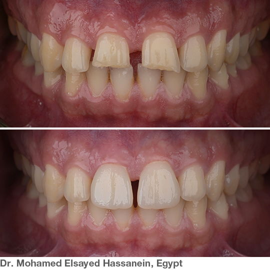 CEREC Tessera: CAD/CAM Blocks | Dentsply Sirona