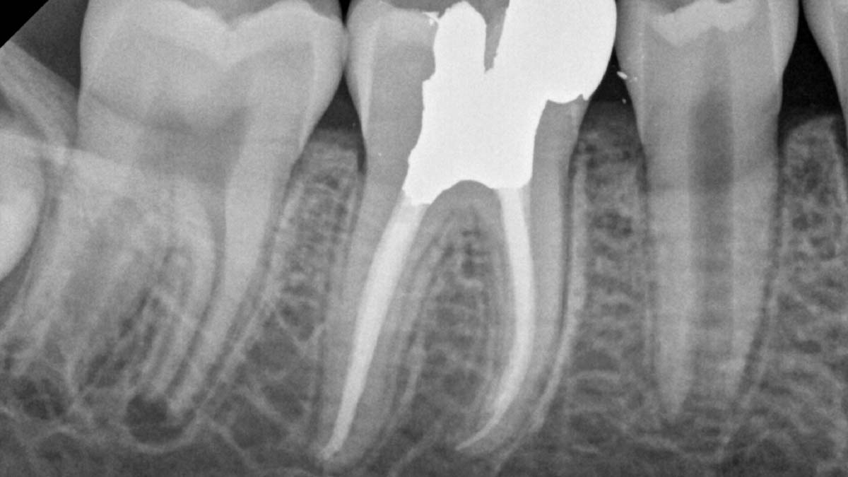 Gutta-Smart Cordless Obturation | Dentsply Sirona USA