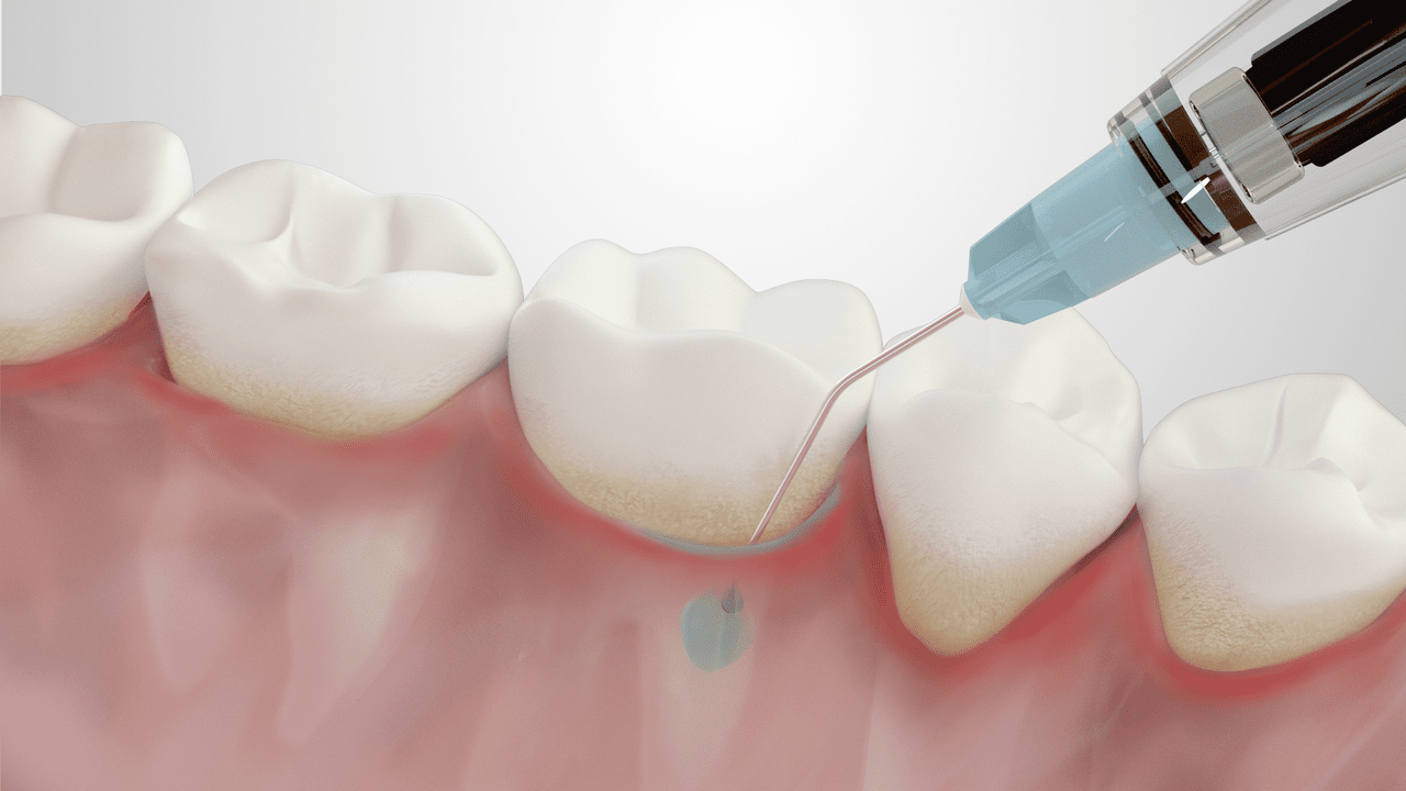 Oraqix Dispenser & Periodontal Gel | Dentsply Sirona USA