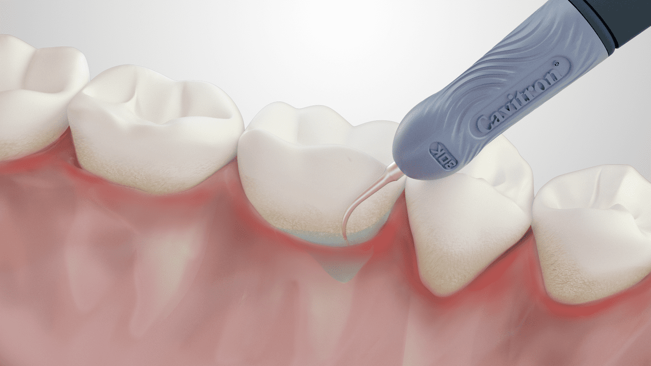 Oraqix Dispenser & Periodontal Gel | Dentsply Sirona USA