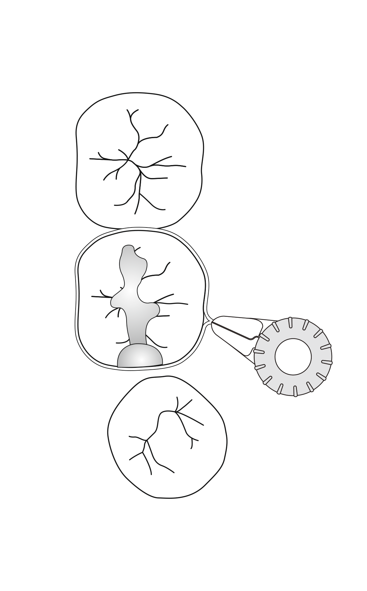 Palodent 360: Circumferential Matrix System | Dentsply Sirona USA