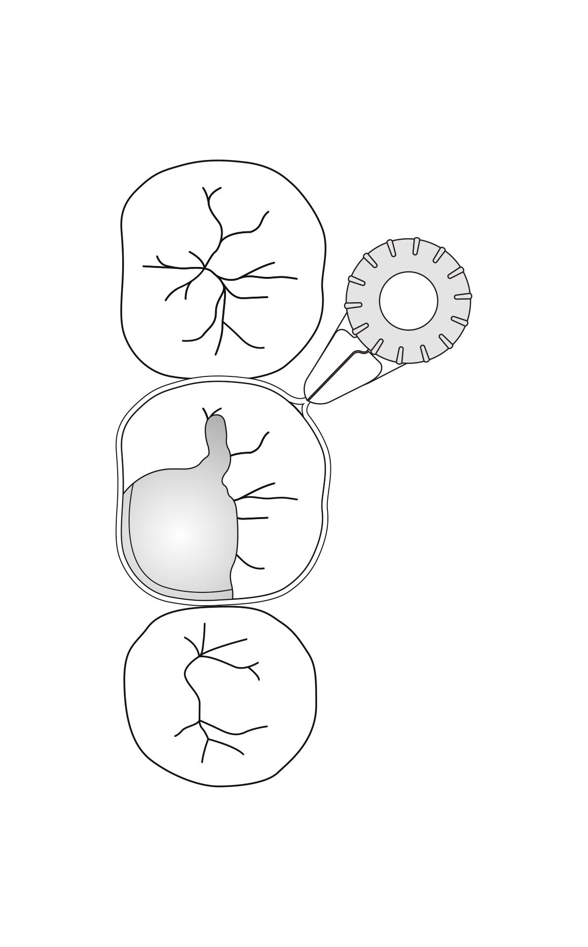 Palodent 360: Circumferential Matrix System | Dentsply Sirona USA
