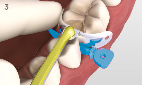 Palodent Plus: Sectional Matrix System | Dentsply Sirona USA