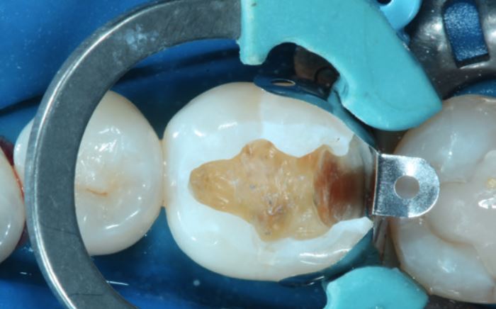 Palodent® Plus: Sectional Matrix System | Dentsply Sirona USA